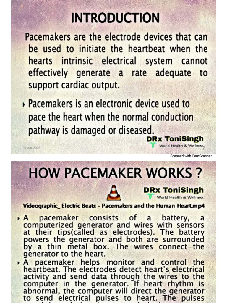 Pacemaker | PDF