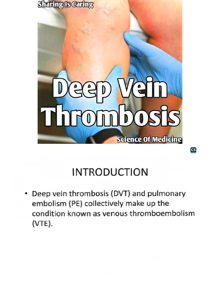 Deep Veins Thrombosis | PDF