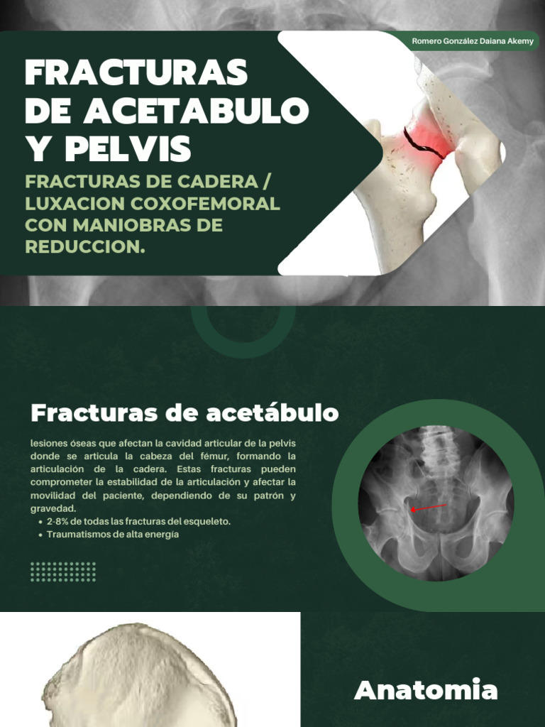Fracturas de Acetábulo y Cadera | PDF | Pelvis | Rodilla