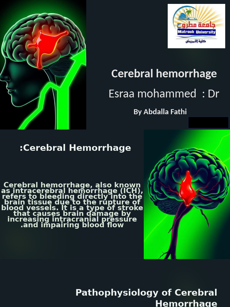 Cerebral Hemorrhage | PDF | Stroke | Vascular Diseases