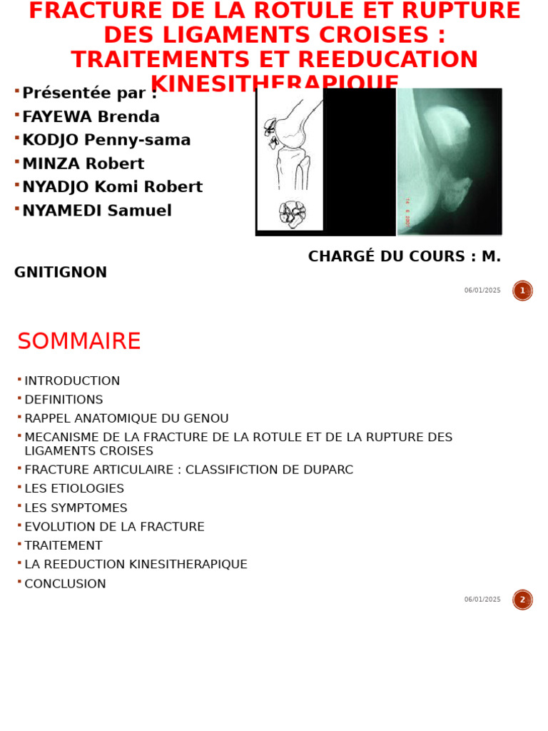 Fracture de la rotule et ligaments croisés : traitement et rééducation ...