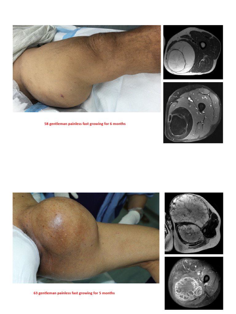 Insights on Soft Tissue Sarcoma Management | PDF | Sarcoma | Medicine