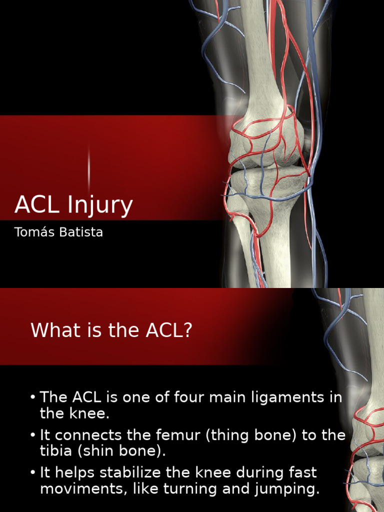 ACL Injury | PDF