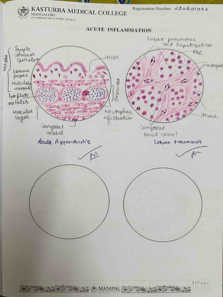 Acute Inflammation Patho | PDF