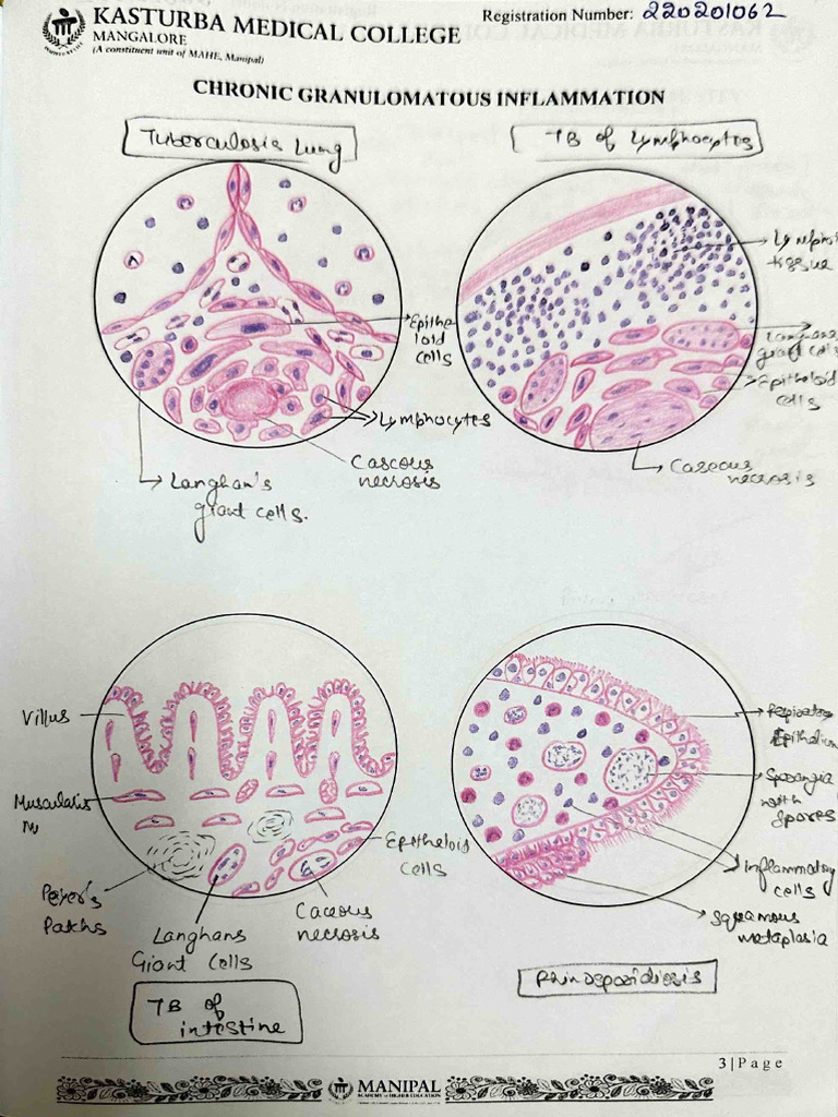 Chronic Inflammation Patho | PDF