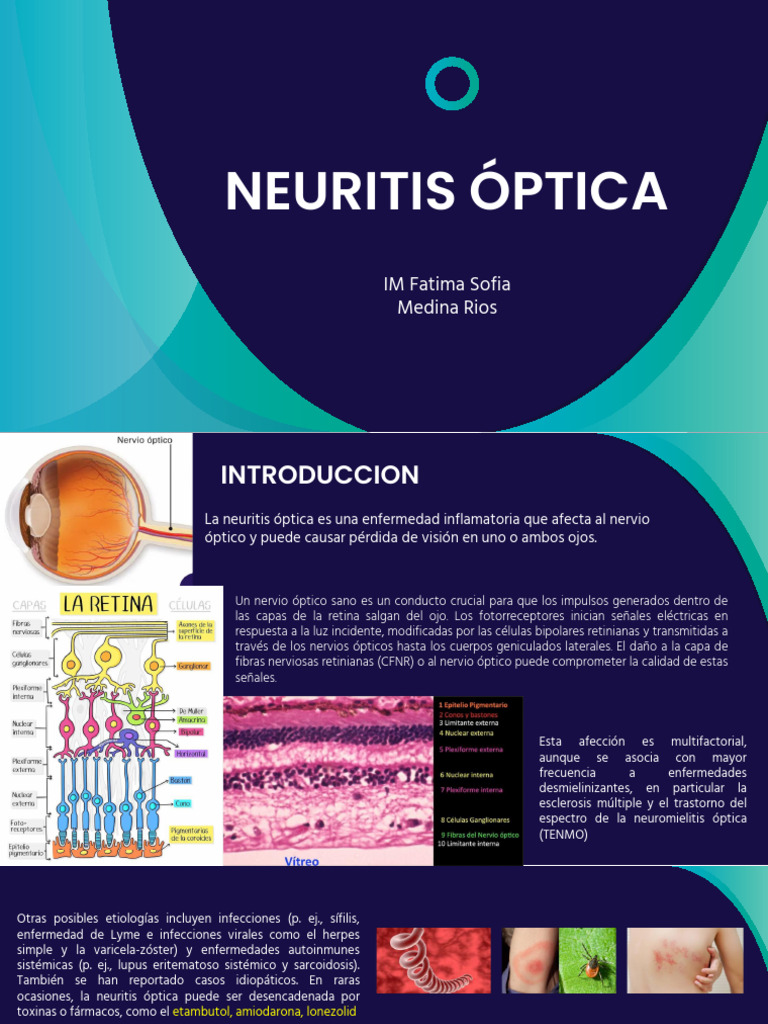 Neuritis Optica | PDF | Nervio | Esclerosis múltiple