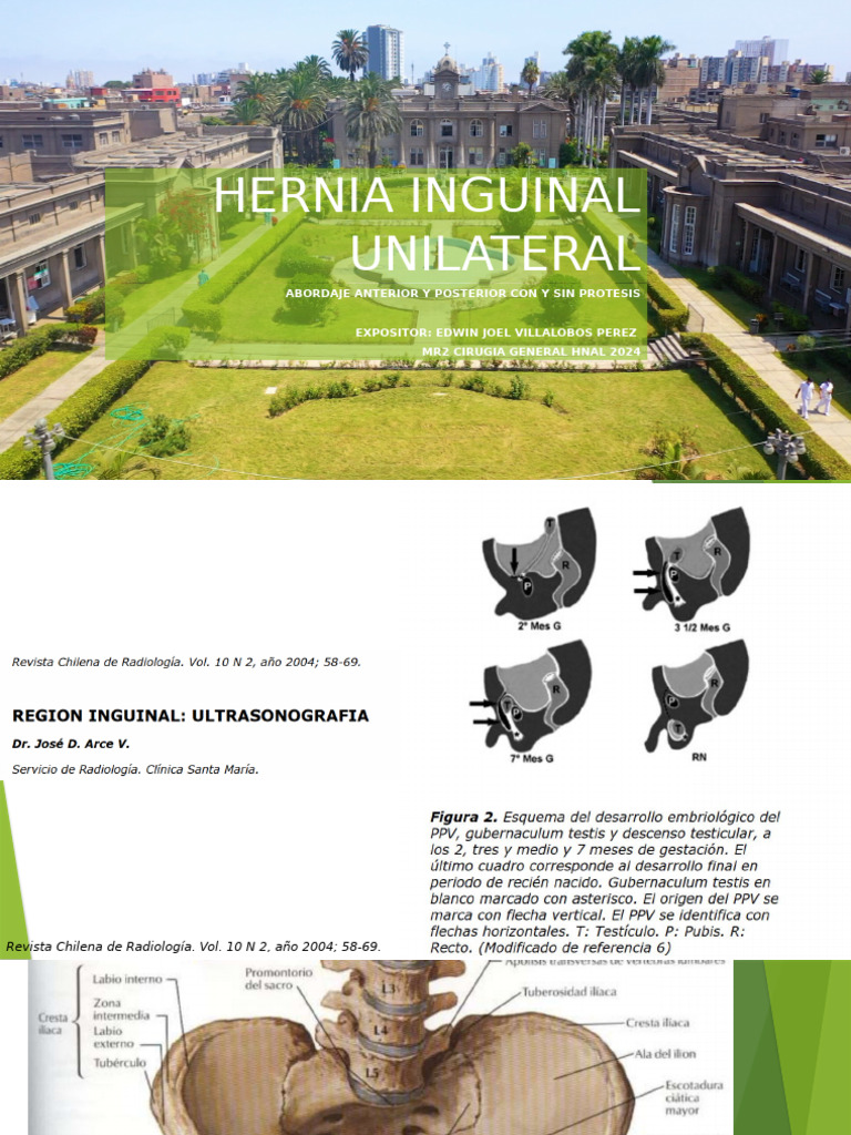 Manejo de Hernia Inguinal | PDF | Especialidades Medicas