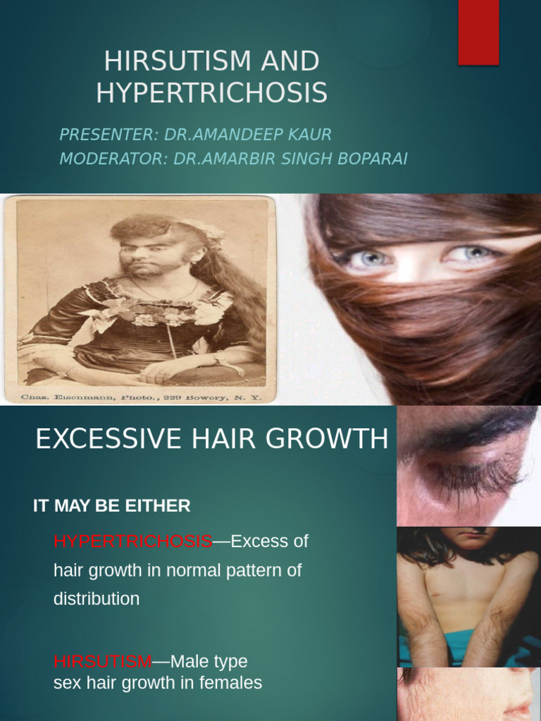Hypertrichosis & Hirsuitism | PDF | Polycystic Ovary Syndrome ...