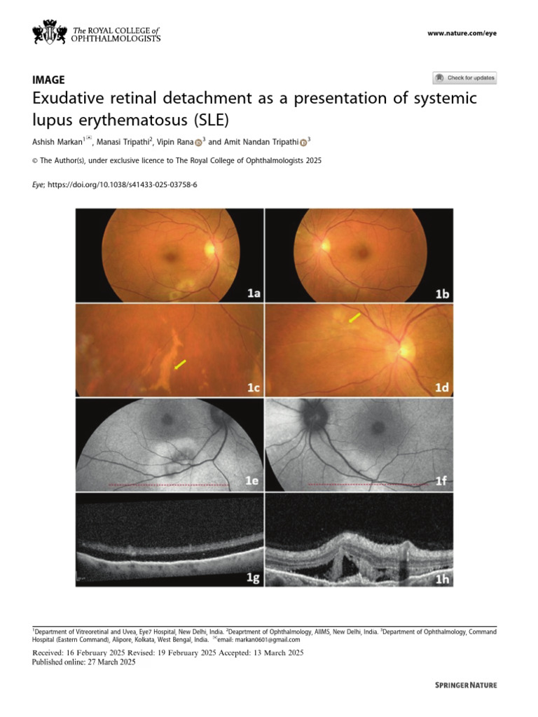 Exudative Retinal Detachment As A Presentation of Systemic | PDF ...