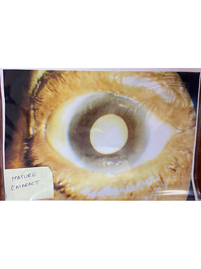 Opthal Cases | PDF