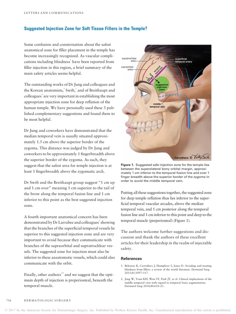 Safe Injection Zones for Temple Fillers | PDF | Medical Specialties ...