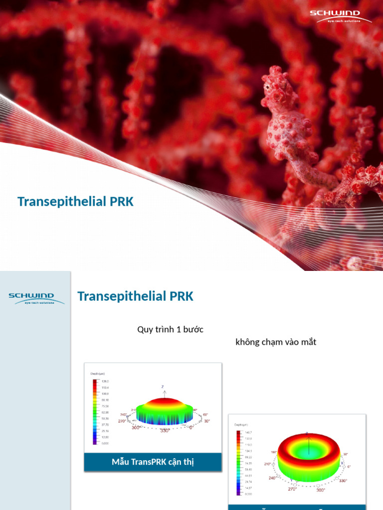 Transepithelial PRK V4.6 (VN) | PDF
