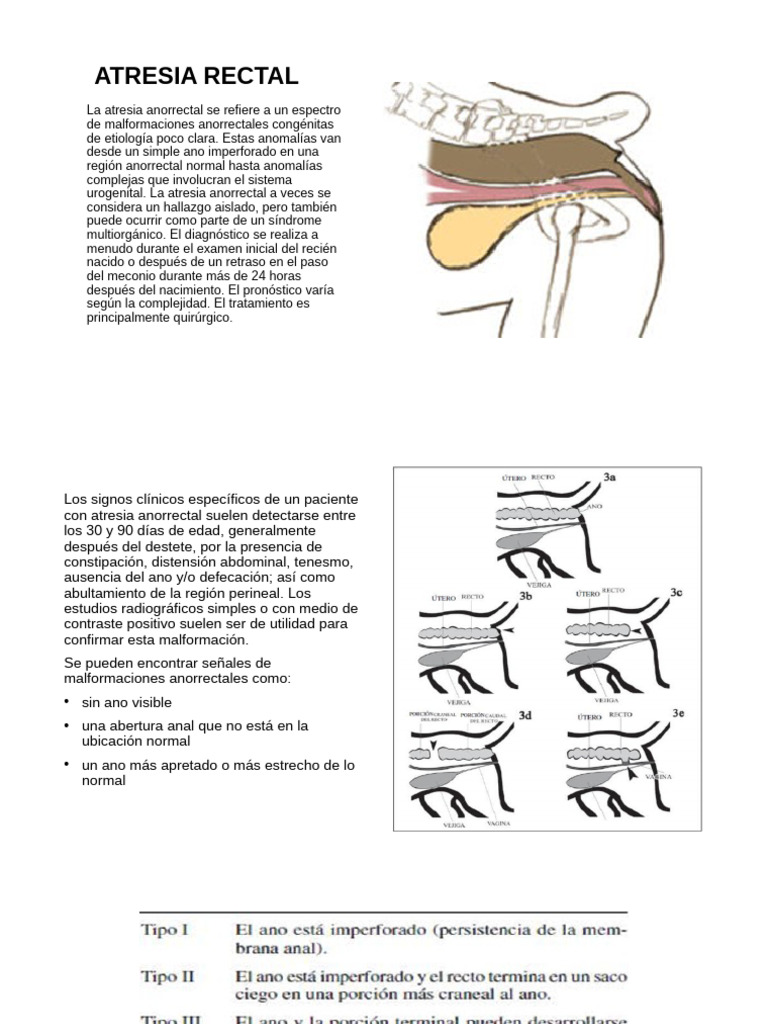 Atrasia Rectal | PDF