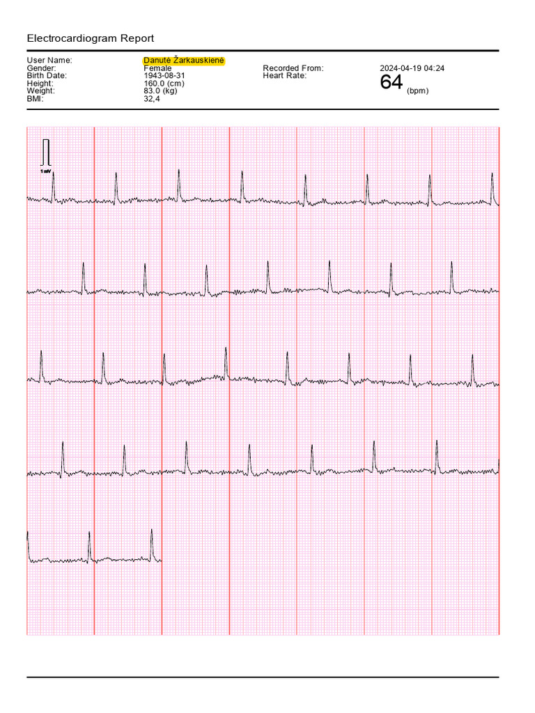 Female ECG Report Summary | PDF