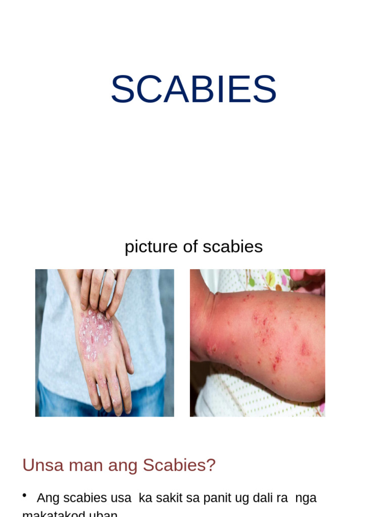 Scabies | PDF