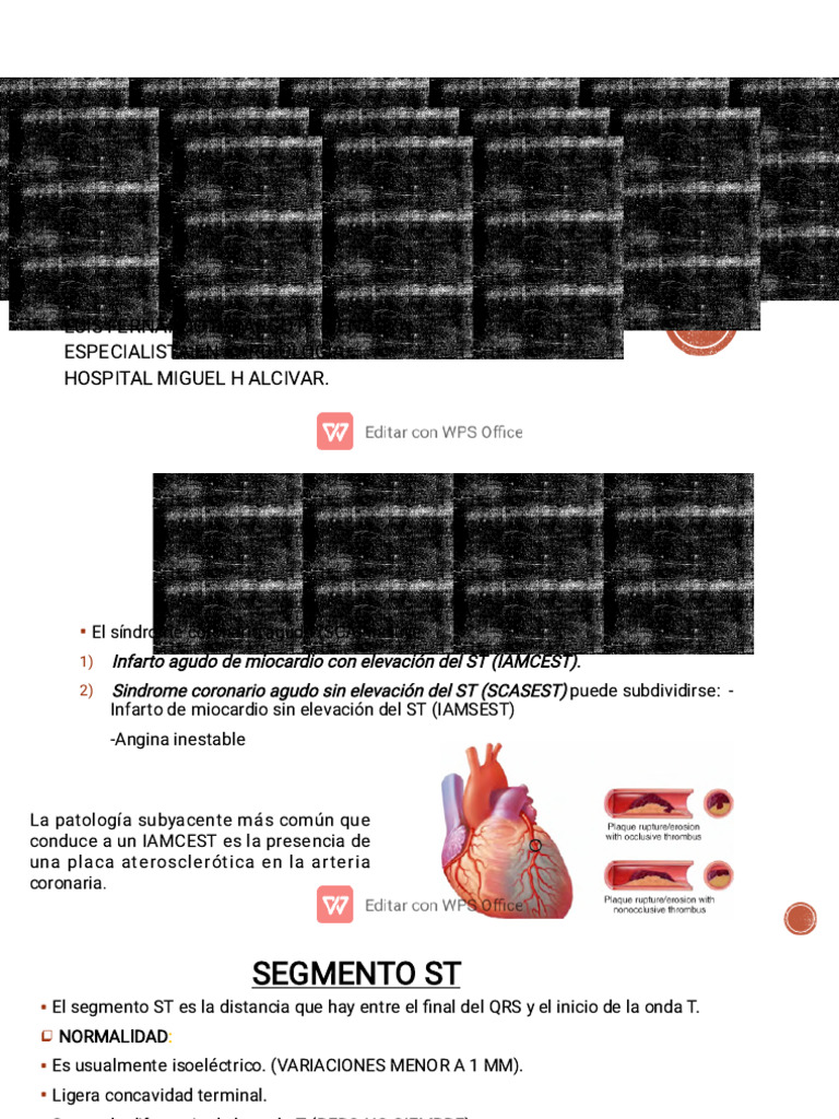 Manejo SCA EST 2025 | PDF | Medicina CLINICA | Causas de la muerte