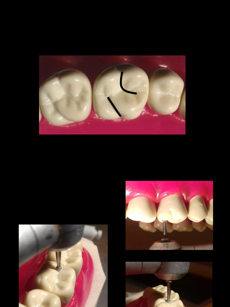 VOP Tallado para AMALGAMA | PDF