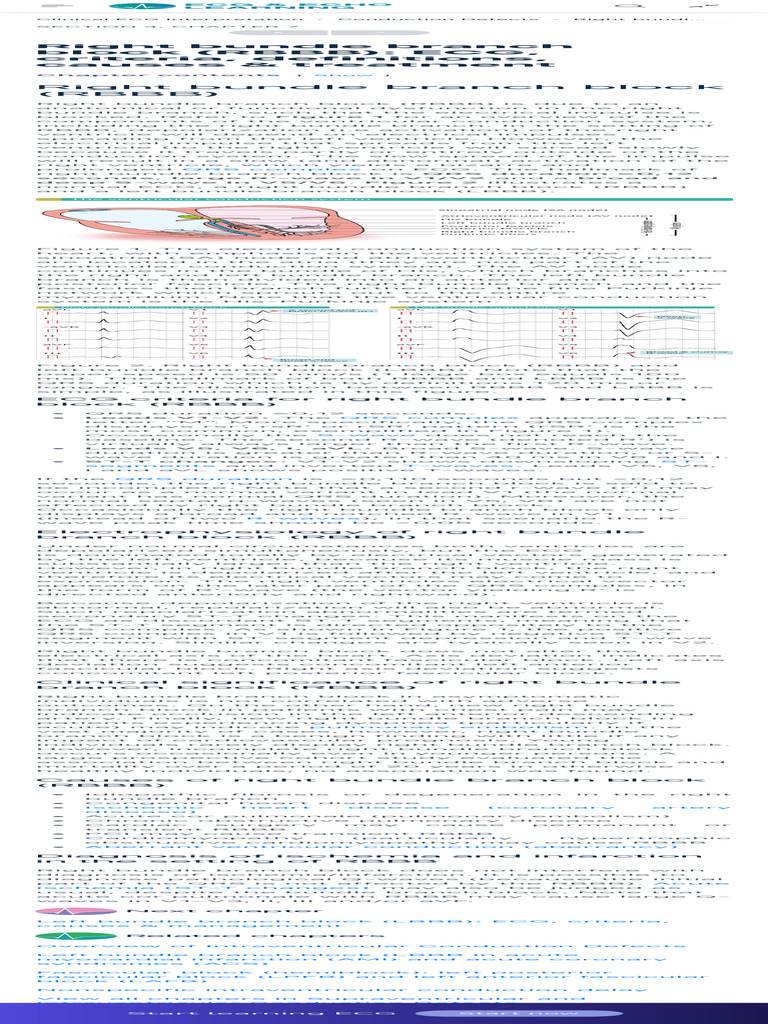 Right Bundle Branch Block (RBBB) ECG, Criteria, Definitions, Causes ...