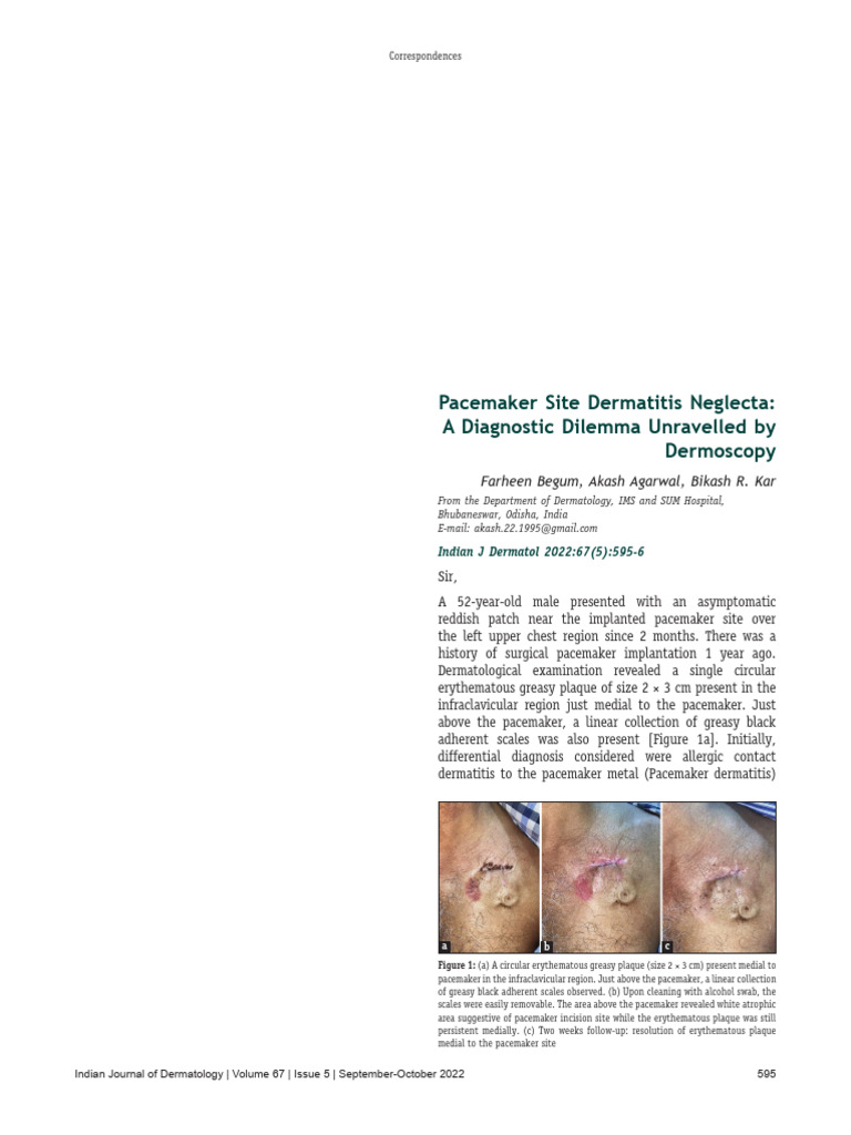 Pacemaker Site Dermatitis Neglecta Case | PDF | Dermatitis | Artificial ...