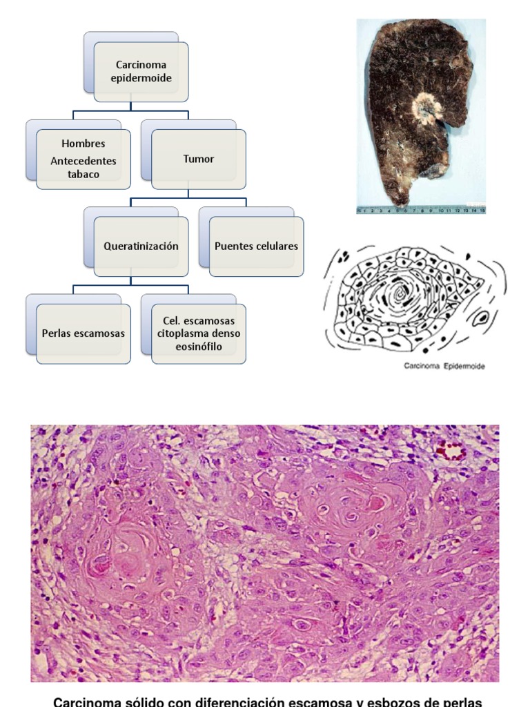 Carcinoma Epidermoide | PDF