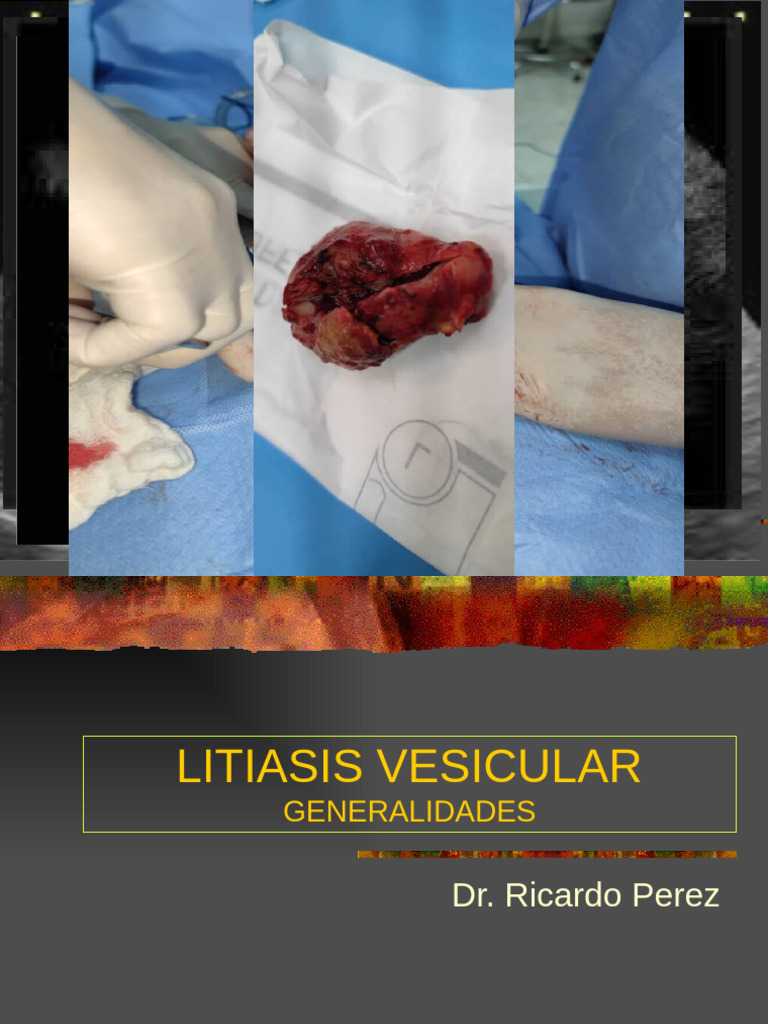 Litiasis Vesicular UNERG | PDF | Bilis | Hígado