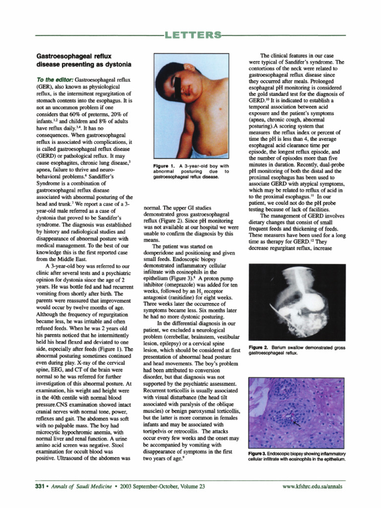 Sandifer Sydrome (GERD) Presenting As Dystonia | PDF | Gastroesophageal ...