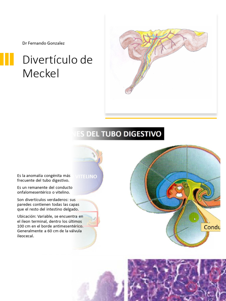 Divertículo de Meckel | PDF | Gastroenterología | Enfermedades y trastornos