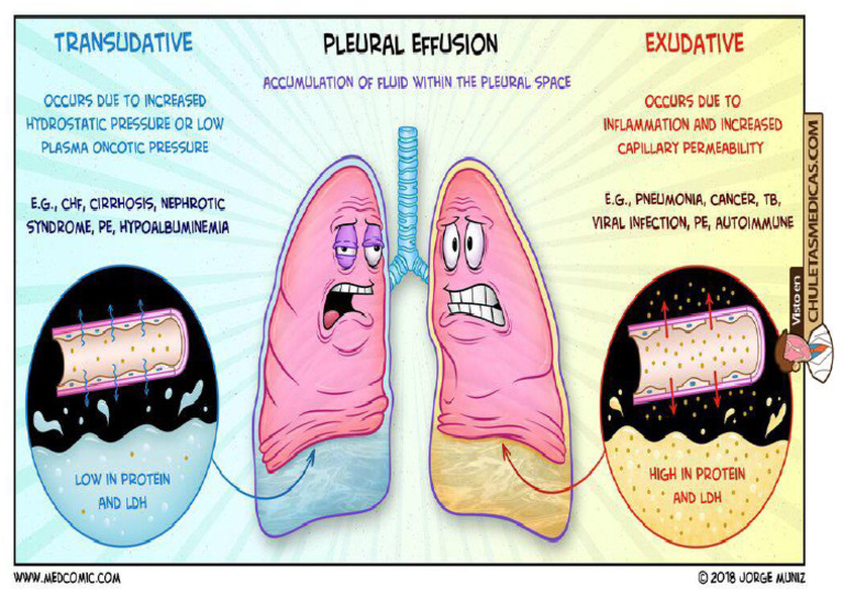 Derrame Pleural Infografia | PDF
