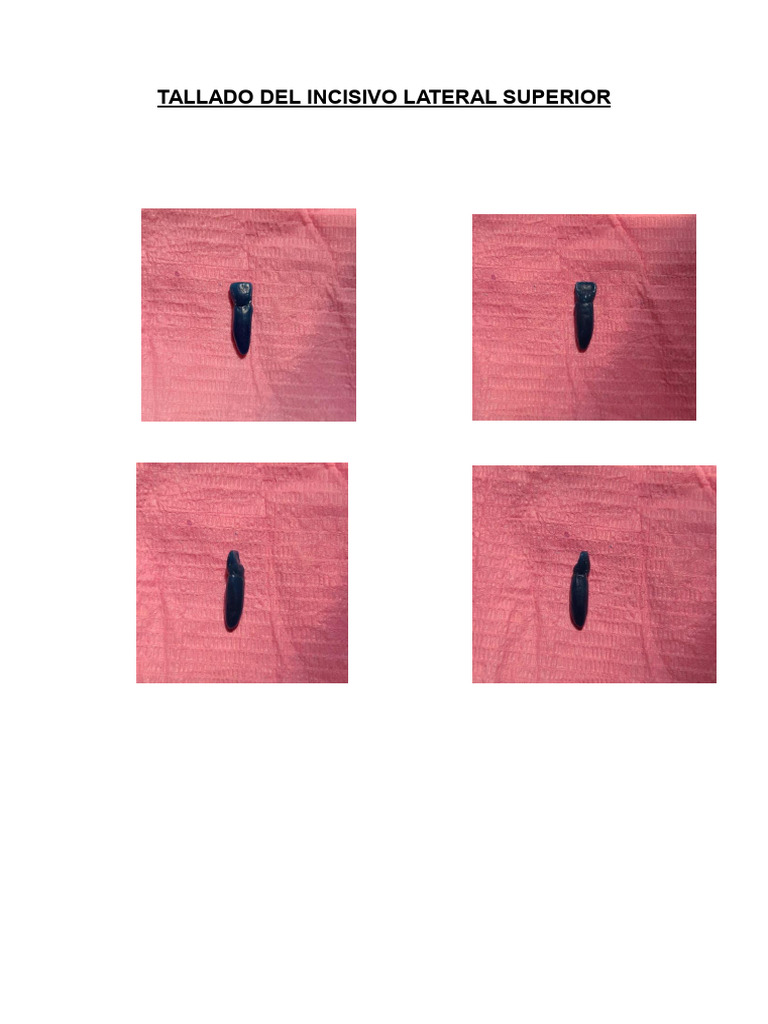 Tallado Del Incisivo Lateral Inf-1 | PDF