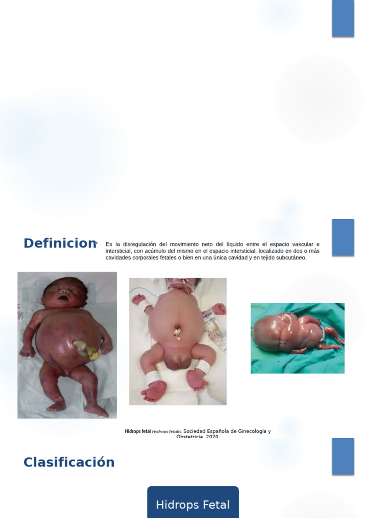 Hidrops Fetal | PDF | Feto | Especialidades Medicas