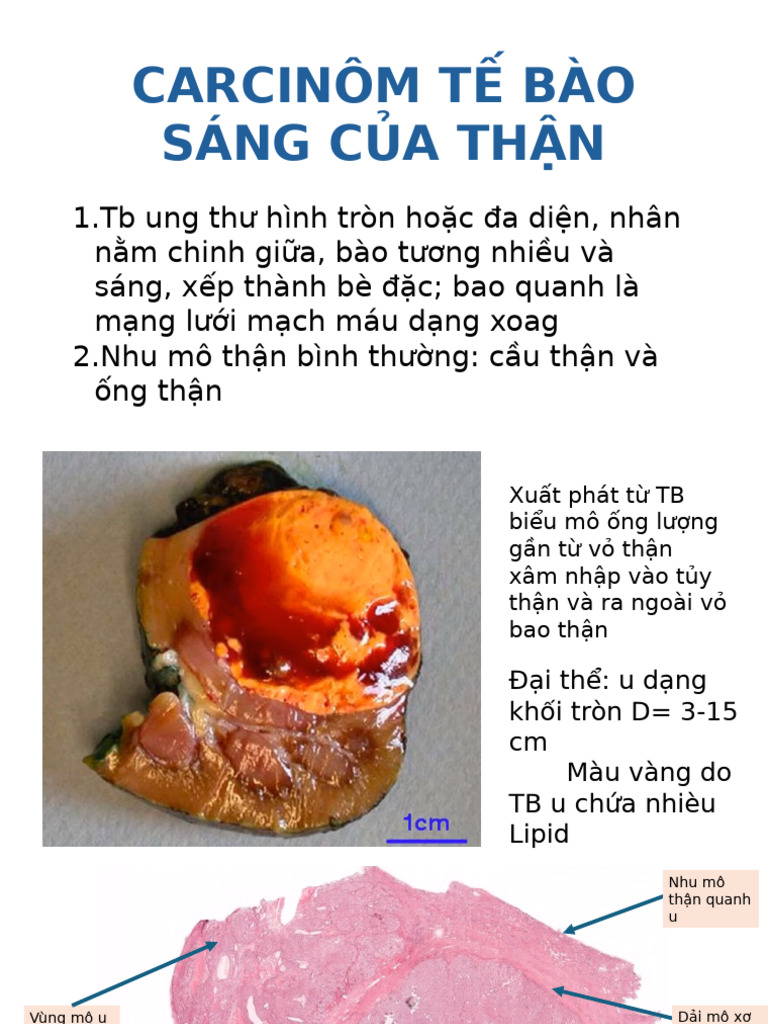 5-Carcinom TB Sáng Của Thận | PDF