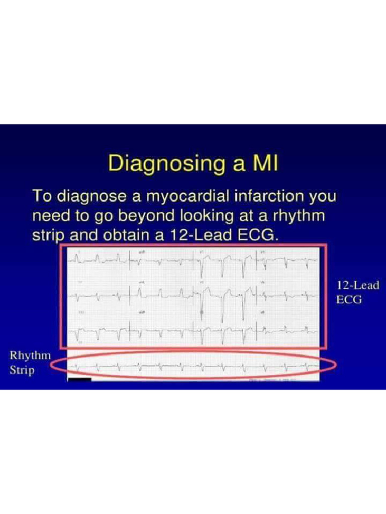 How To Diagnose Myocardial Infarction | PDF