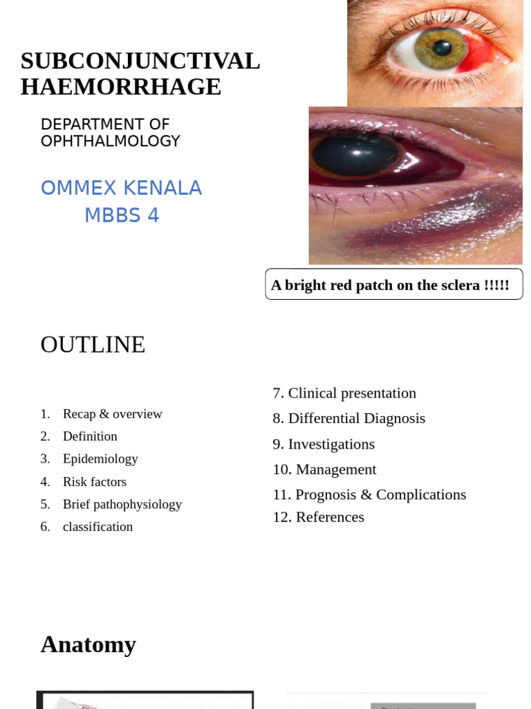 Subconjunctival Haemorrhage | PDF | Bleeding | Cough