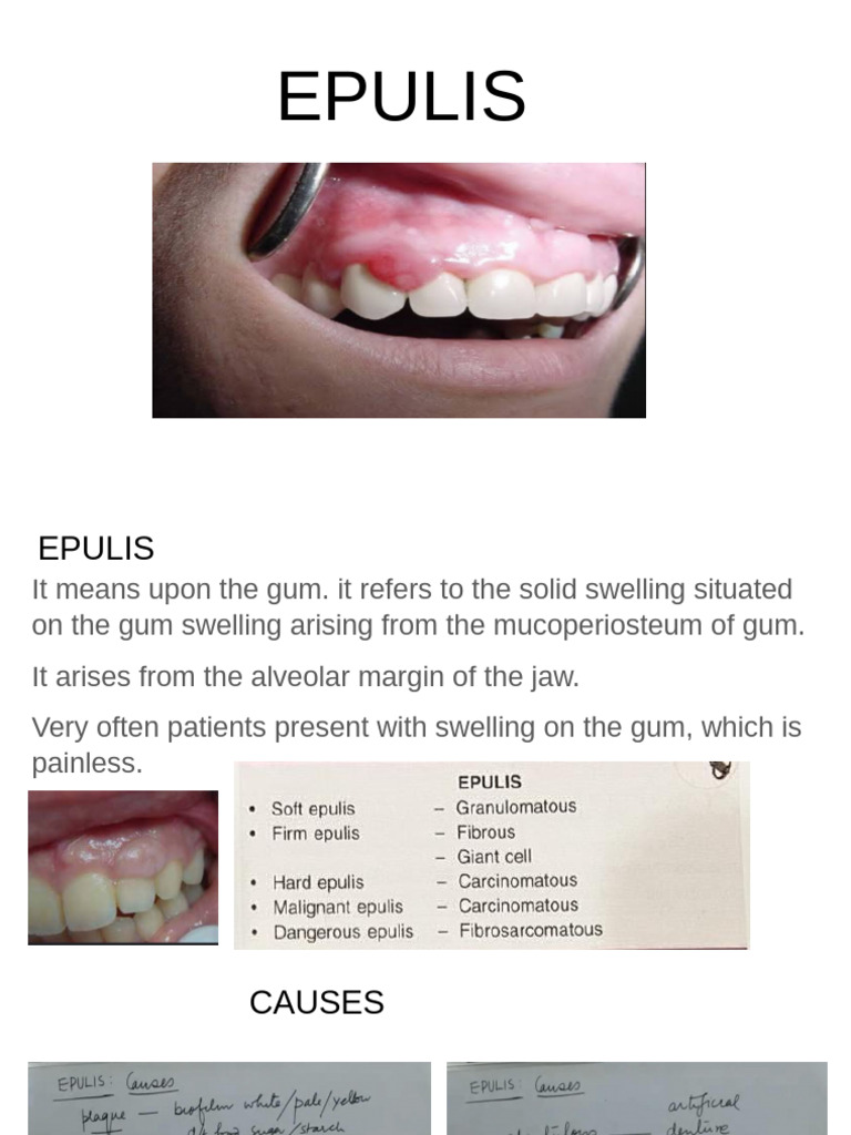 Epulis | PDF