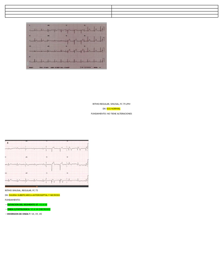 Extrasistole Supraventricular Ventricular | PDF
