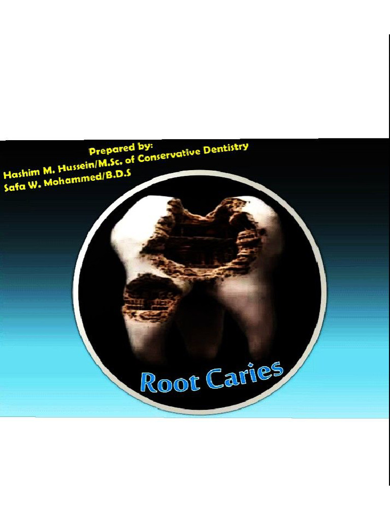 Root Caries Endo | PDF