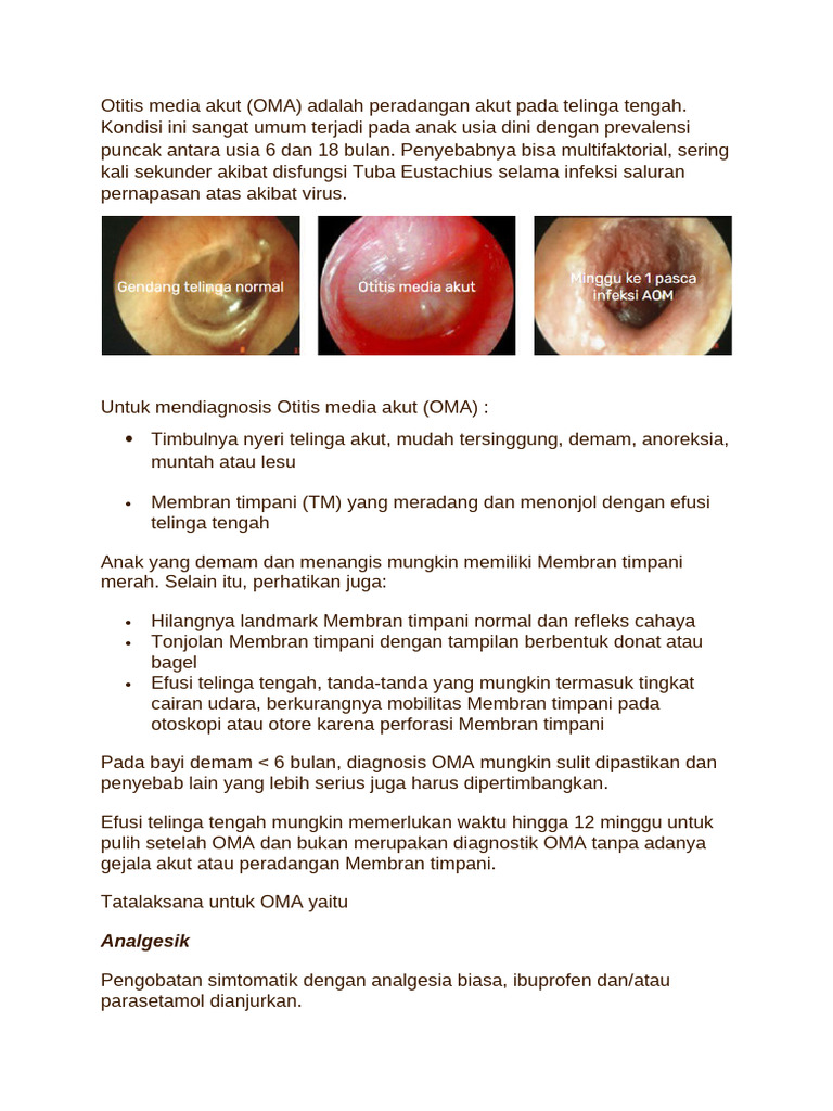 Diagnosis dan Terapi Otitis Media Akut | PDF
