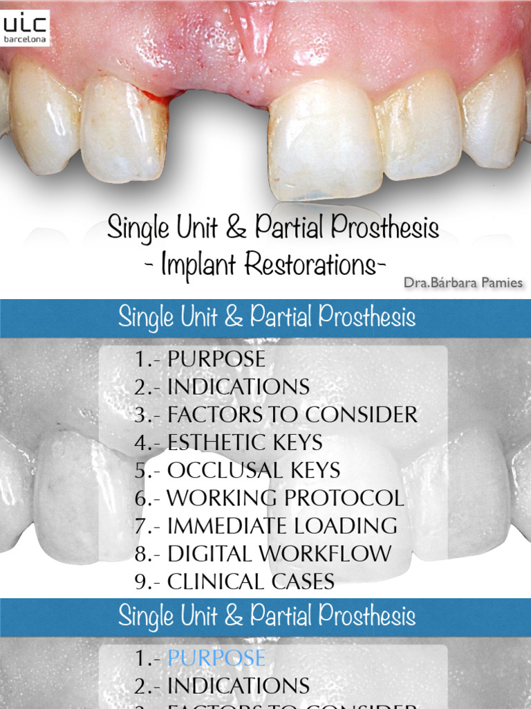 2020 Single Unit & Partial Prosthesis | PDF | Dental Implant | Prosthesis