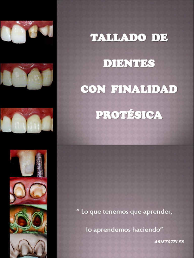 Tallado De Dientes Con Finalidad Protésica
