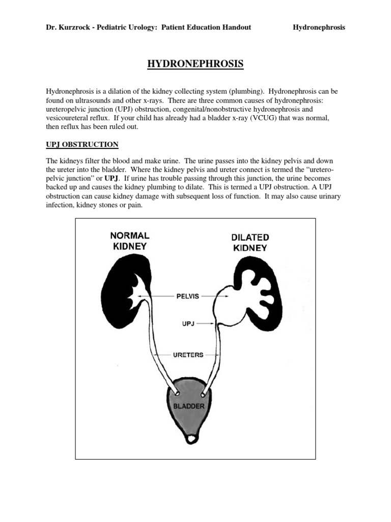 Hydronephrosis | PDF | Urinary System | Genitourinary System