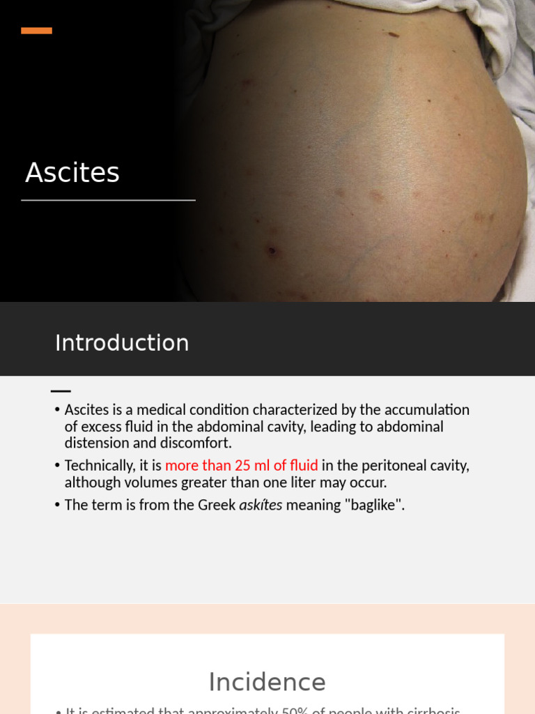 Ascites - Definition, Causes, Pathophysiology, Signs and Symptoms ...