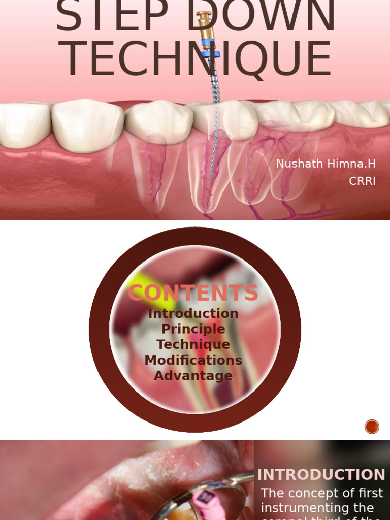 Step Down Technique | PDF | Medical Specialties | Dentistry Branches