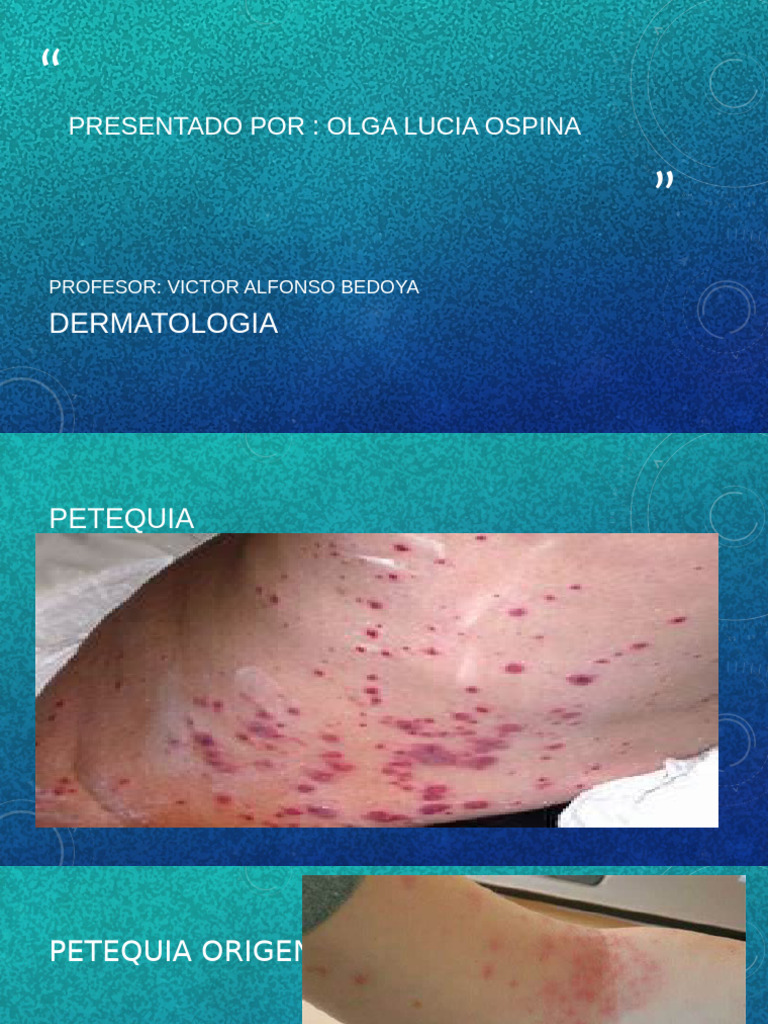 Causas y Tratamientos de Petequias | PDF | Leucemia | Sangre