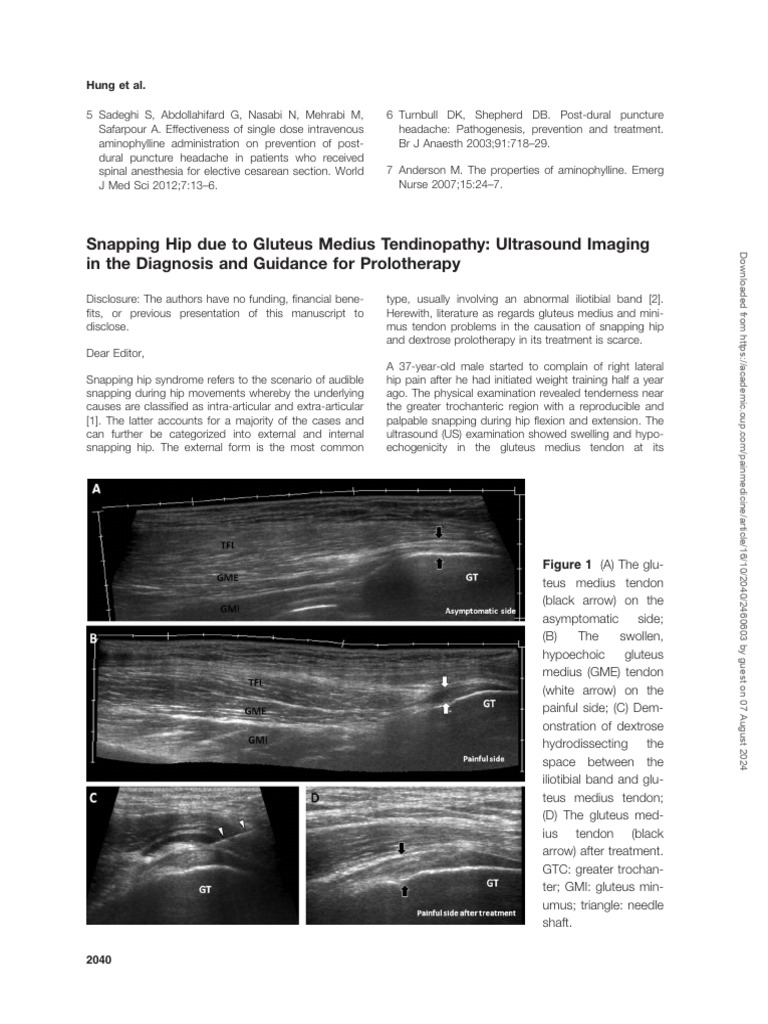 Snapping Hip D:T Gluts Med Tendinopathy Guidance For Prolotherapy | PDF | Medical Specialties ...