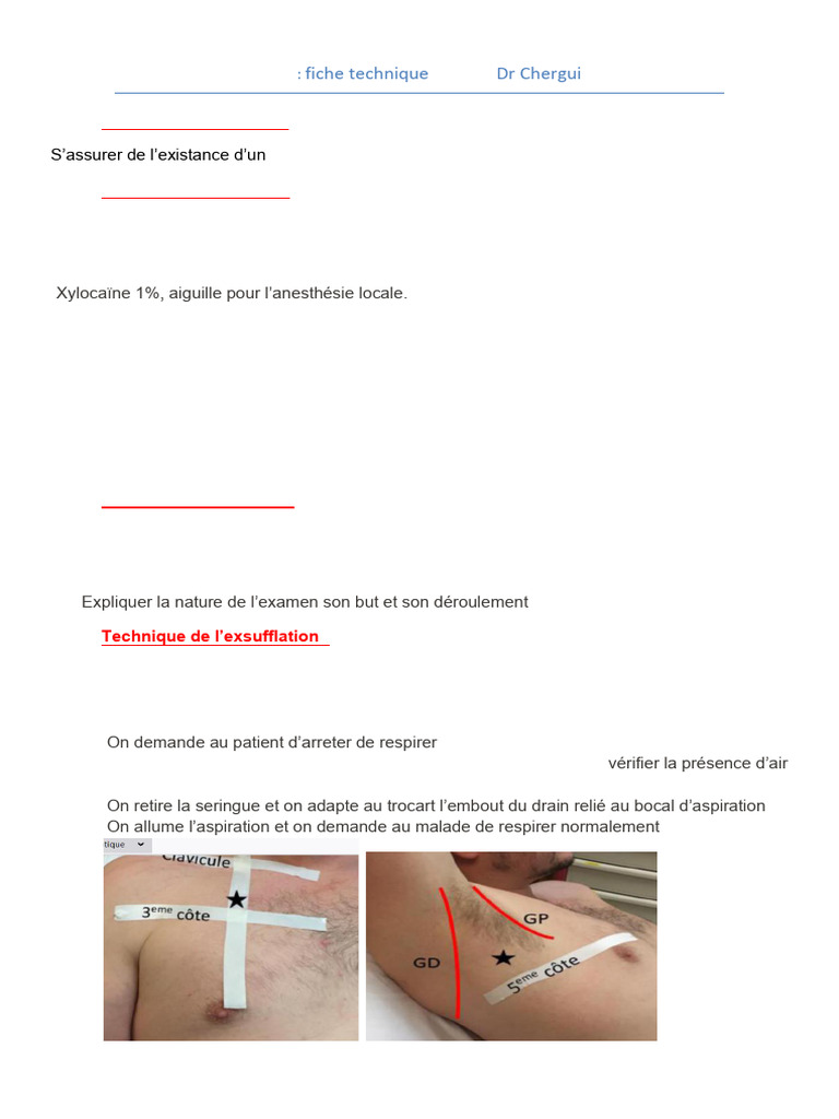 Exsufflation pleurale en pneumothorax | PDF