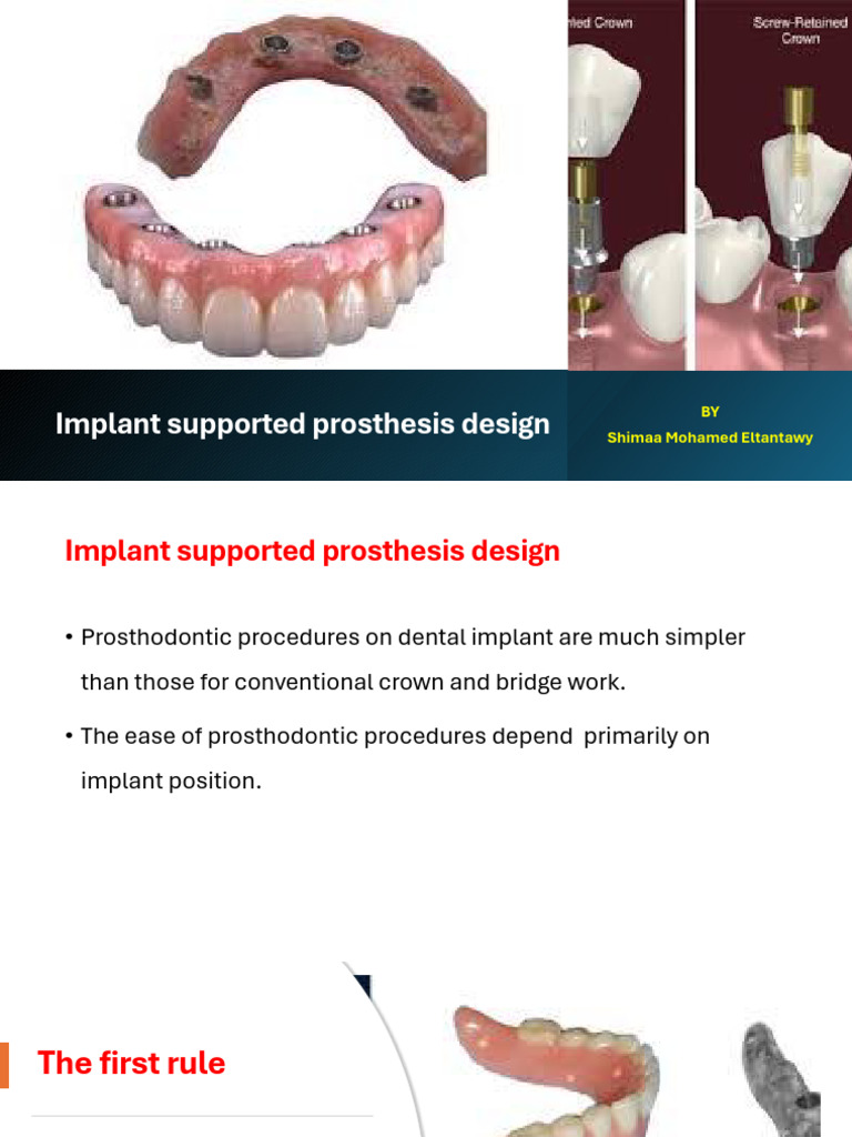 Implant Prosthesis Design | PDF | Dental Implant | Dentistry Branches