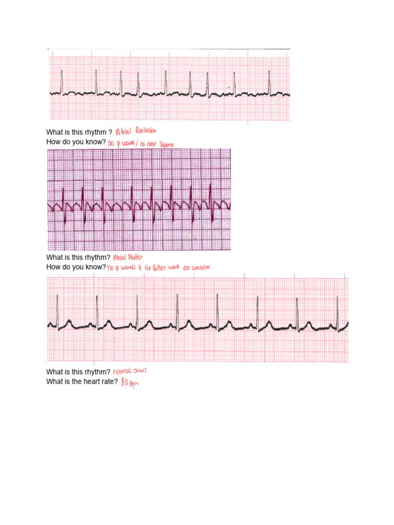 Atrial Rhythms Assignment | PDF