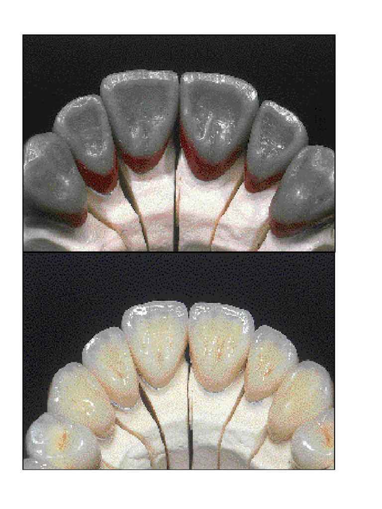 The International Journal of Periodontics & Restorative Dentistry | PDF ...