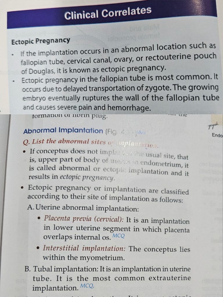 Ectopic Pregnancy or Abnormal Implantation | PDF