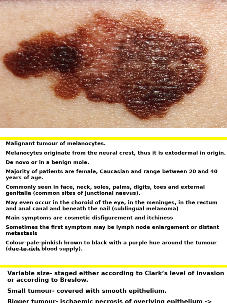 Malignant Melanoma M. Mithun 17.10.2024 | PDF | Melanoma | Skin